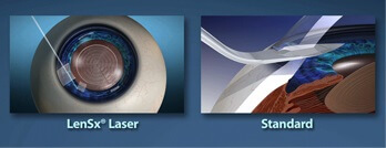 LenSx-New Laser Technology for Cataract Surgery | MedHelp24